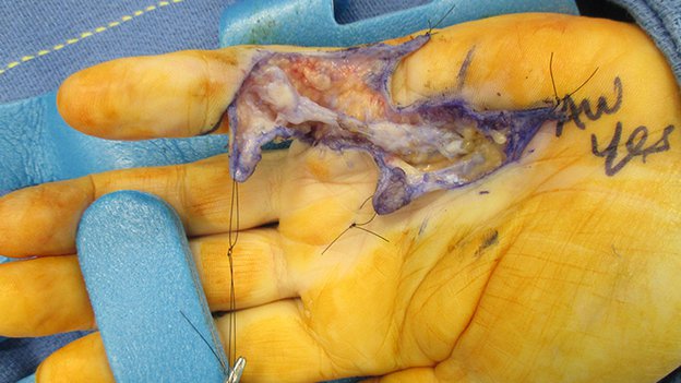 Restoring hand function impaired by Dupuytren’s contracture | Plastic ...