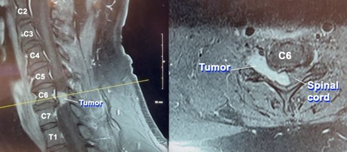 'Every day is a blessing': 11-hour surgery removes dangerous, rare ...