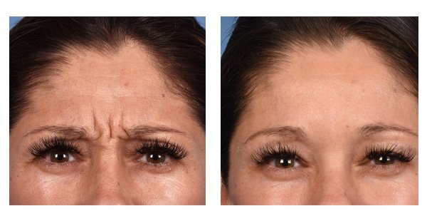 Botox, Dermal Fillers, and Laser Skin Resurfacing Before and After ...