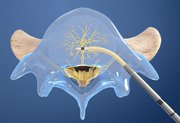 New Intracept procedure provides lasting relief for chronic low-back ...