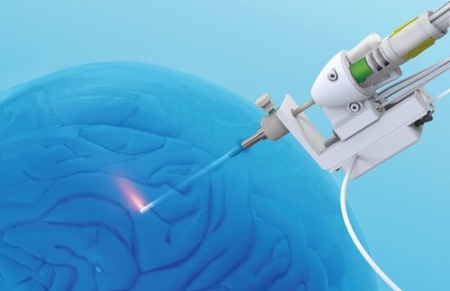 Laser surgery offers hope for patients living with epilepsy and brain ...