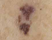 What does skin cancer look like? Pictures, plus prevention tips ...