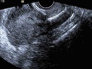 What happens if I get pregnant with an IUD? | Your Pregnancy Matters ...