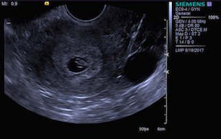 Part one: What are the common causes of miscarriage? | Your Pregnancy ...