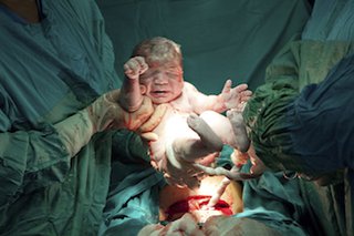 Why you should ask about your hospital’s C-section rate | Your ...