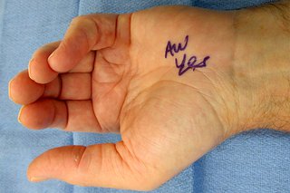 Restoring hand function impaired by Dupuytren’s contracture | Plastic ...