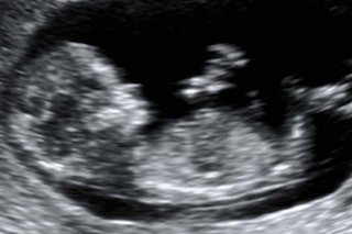 Is it OK to use a hot tub during early pregnancy? | Your Pregnancy ...