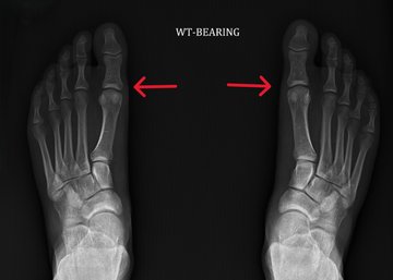 Turf toe: What athletes need to know about this painful injury ...