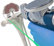 Robotic knee replacement surgery enhances precision, personalization ...