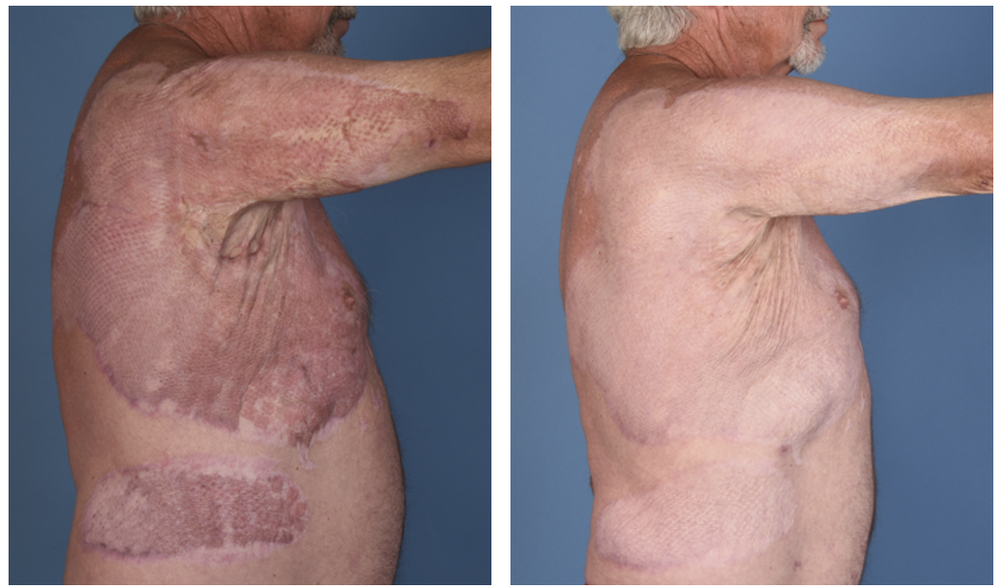 Laser therapy smooths and flattens raised scars after burn injury or ...