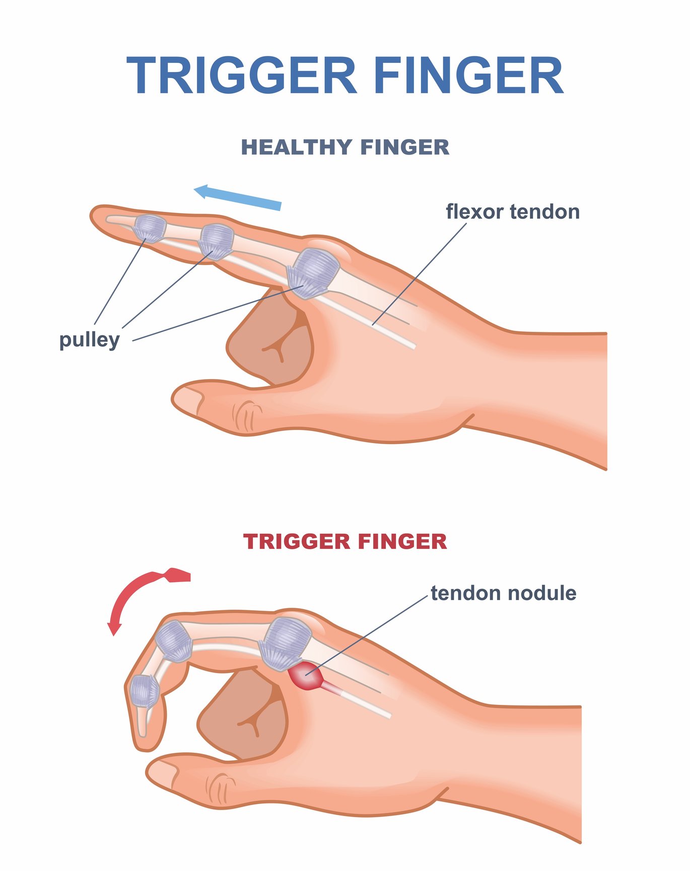 Fixing trigger finger with a fresh approach | Plastic Surgery | UT ...